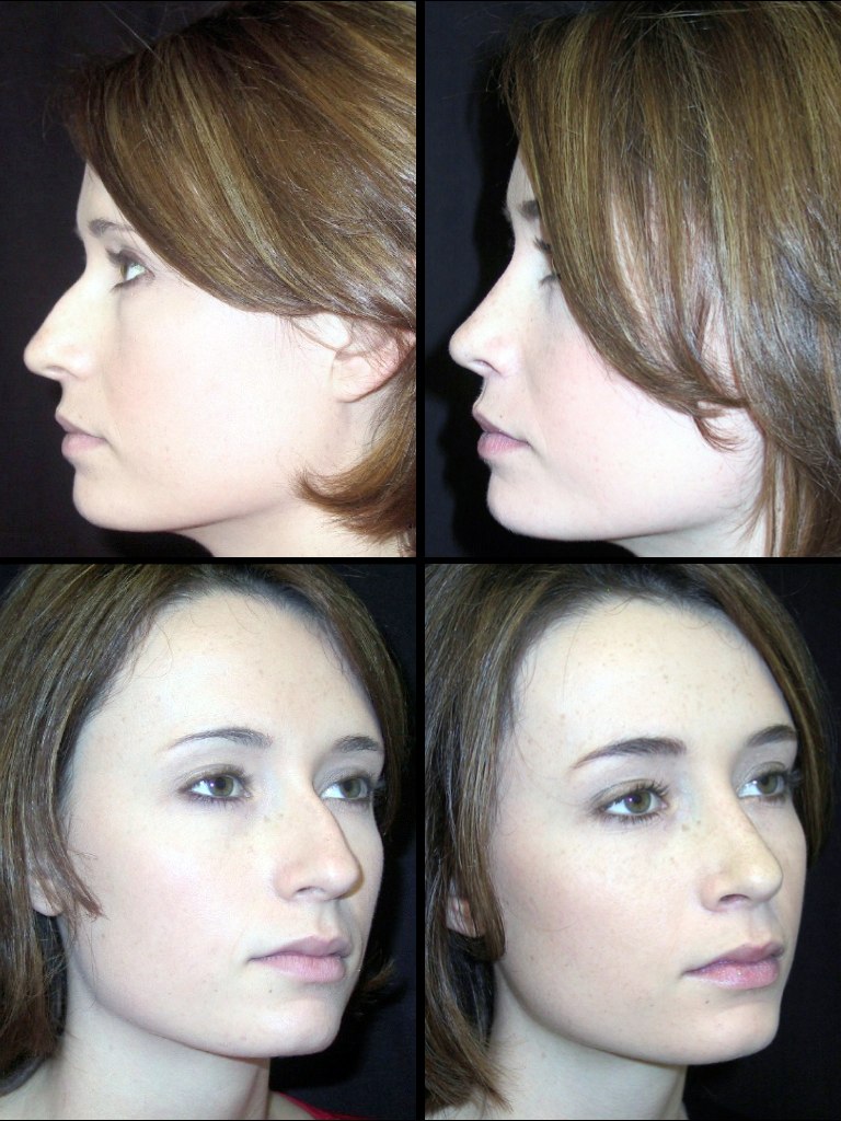 RHINOPLASTY, NOSE JOB GALLERY - Dr. Neal Handel, Beverly Hills Plastic ...